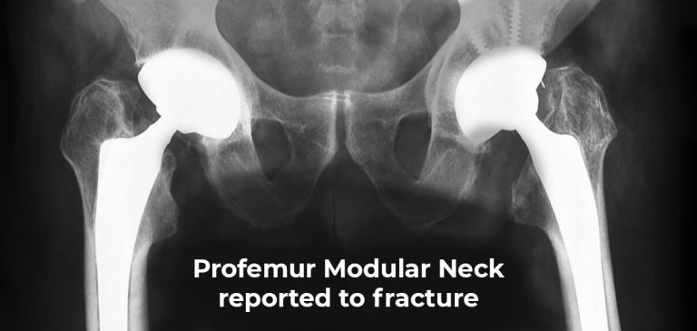 Profemur Modular Neck Investigation - Preuss | Foster Law