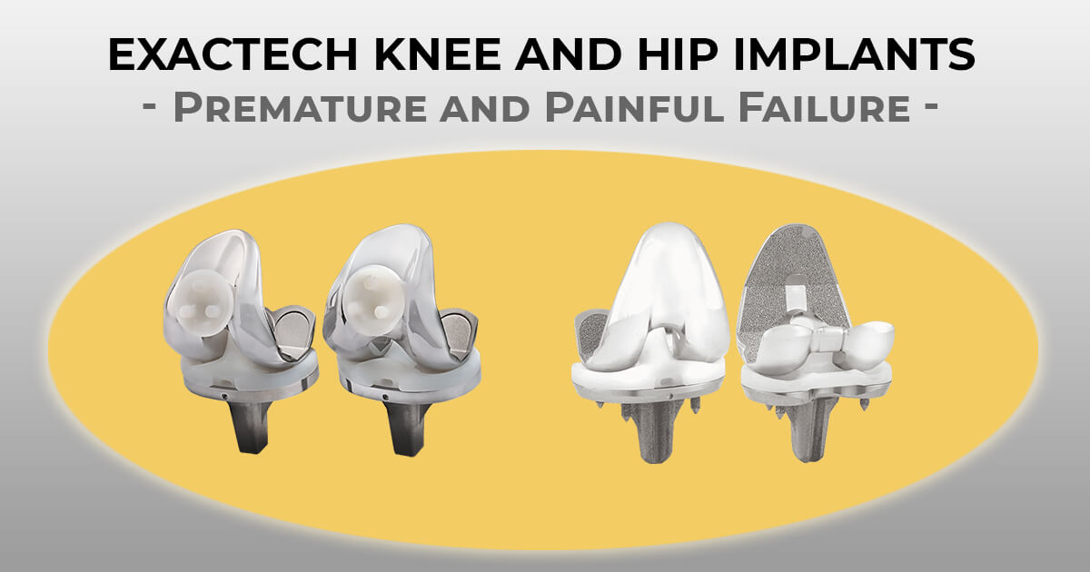 Exactech Knee and Hip Implant Investigation - Preuss | Foster Law
